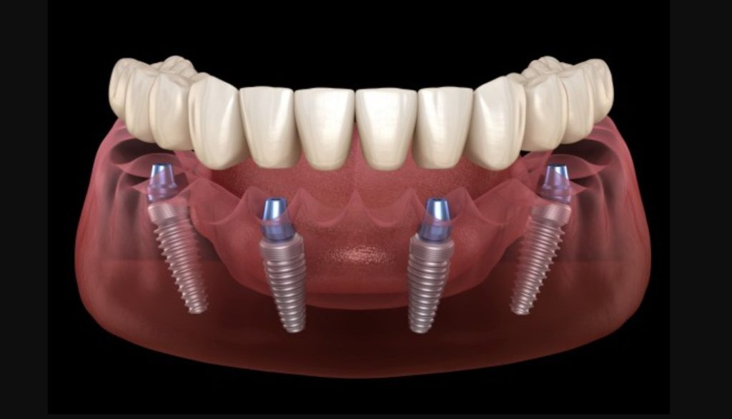 Affordable dentures and implant prices